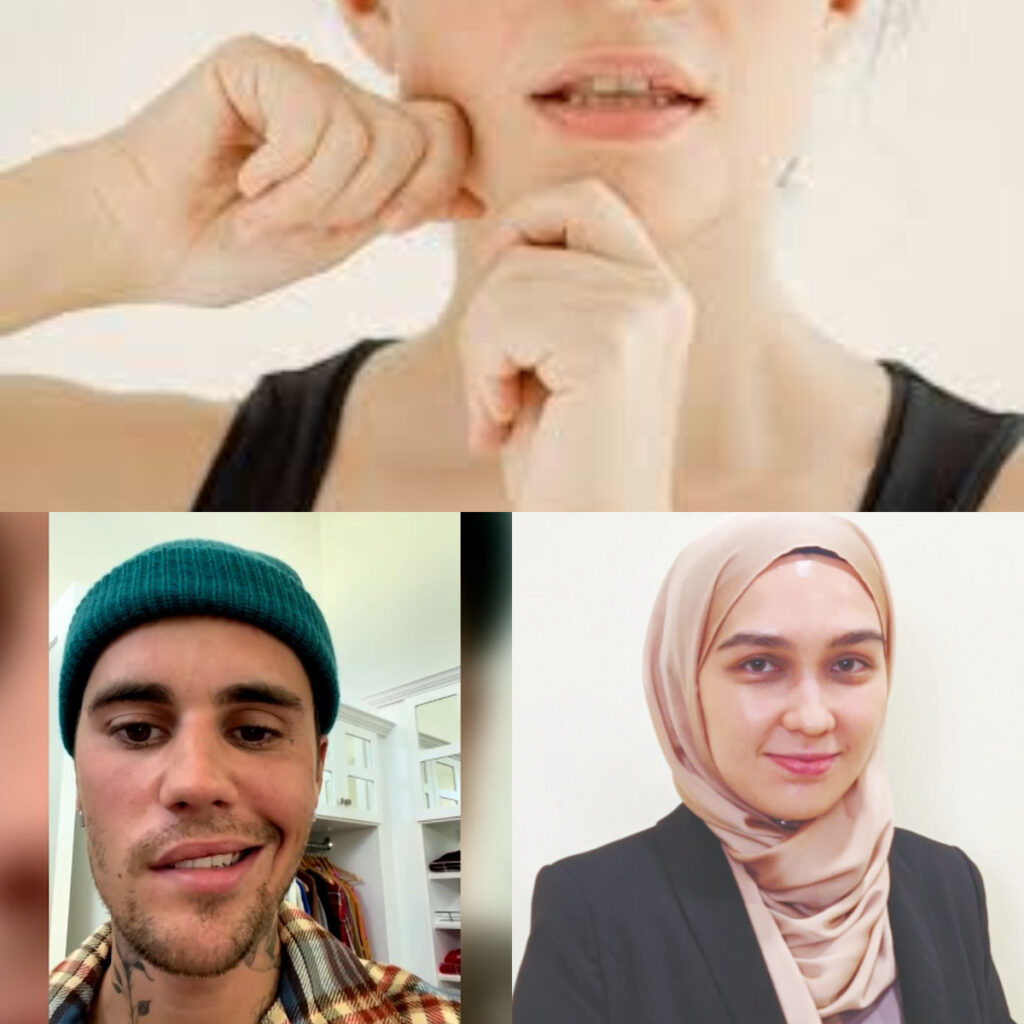 Sindrom Ramsay Hunt penyakit jarang jumpa tak sama dengan Bell’s Palsy ...